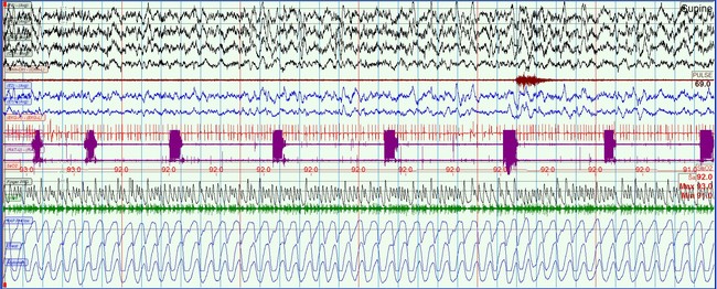 Sleep Medicine Board Exam Practice Questions